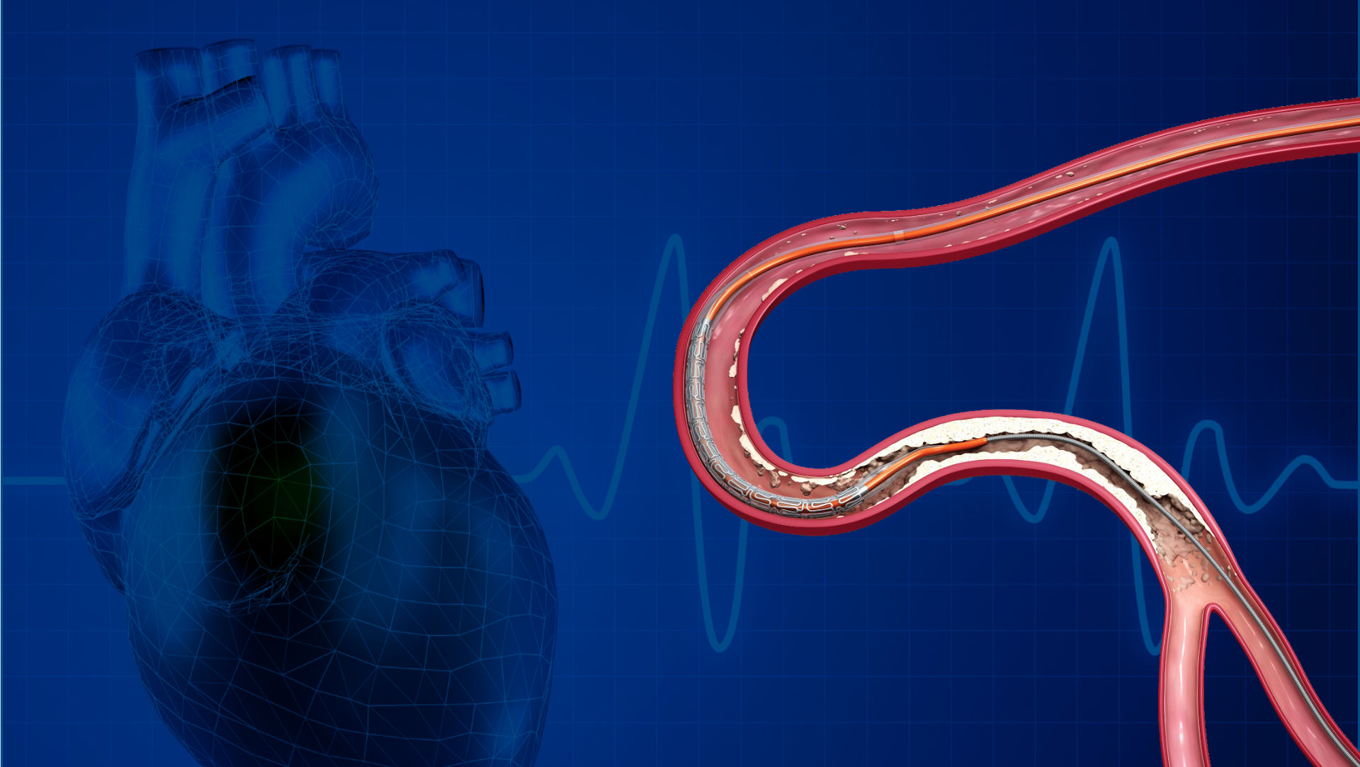 PCI Cardiology - Una mejor manera de llegar a tu corazón
